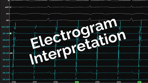 Electrogram Interpretation 10 Ep Essentials