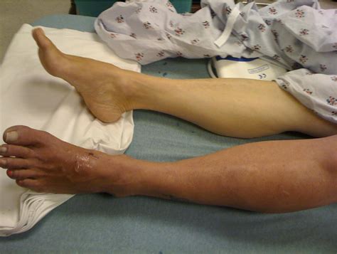 Dangers Of Edema In Legs Edema Causes Symptoms And Treatment Hqru