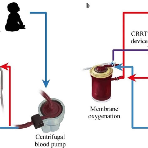 The Connection Of Ecmo With Continuous Renal Replacement Therapy Crrt