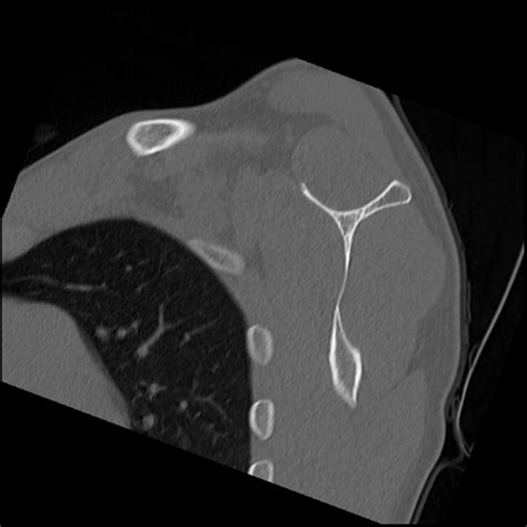 Normal Ct Shoulder Radiopaedia 60106 67676 Sagittal Bone Window Nc