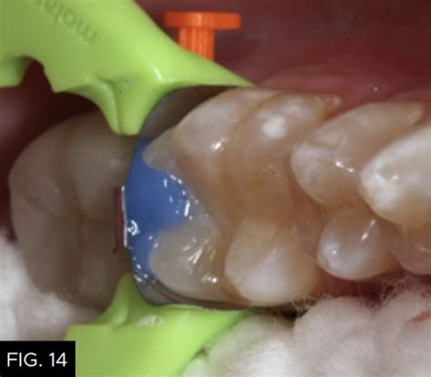Optimizing Aesthetics And Predictability In The Placement Of Posterior Composite Resin