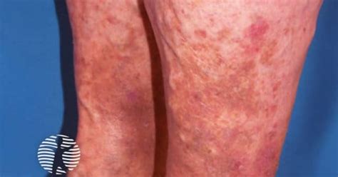 Gravitational Dermatitis Image