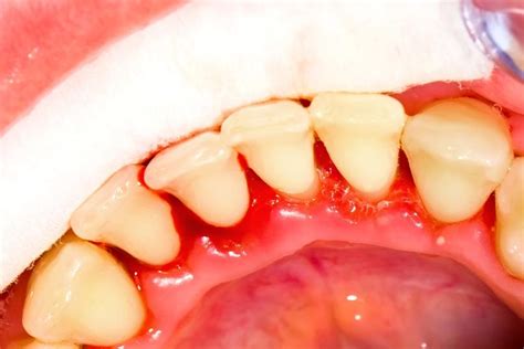 Teeth Gingivitis Causes Symptoms Diagnosis Treatment And Prevention Monash Dental Group