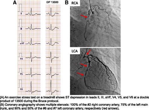 Asymptomatic Myocardial Ischemia A An Exercise Stress Test On A Download Scientific Diagram