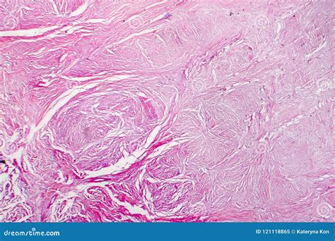 Light Micrograph Of Scar Tissue Stock Image Image Of Scar