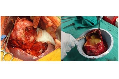 Echinococcal Liver Cyst International Journal Of Clinical And Medical