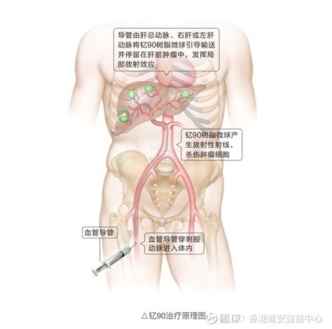 香港肿瘤科医生：钇90疗法一次治疗可针对性控制肝癌细胞！ 有香港临床肿瘤科医生指出，近年引入的sirt 钇90，则同时适用于继发性及原发性肝癌