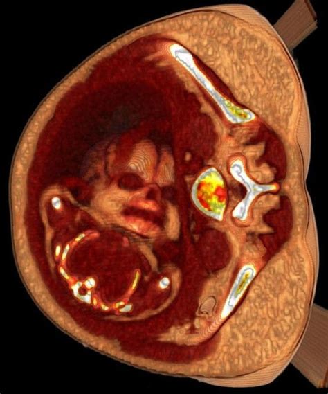 Ct Scan During Pregnancy American Pregnancy Association