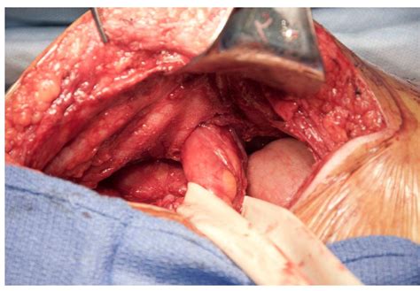 Figure 2 Parastomal Hernia Repair Using The Top Hat