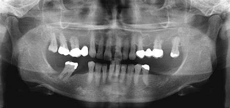 51 Supplement A Pathologic Tooth Migration A Case Report Pocket