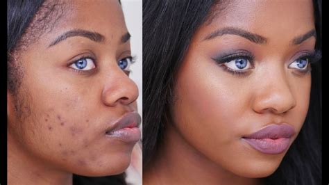 Laser Scar Removal For Dark Skin What To Expect