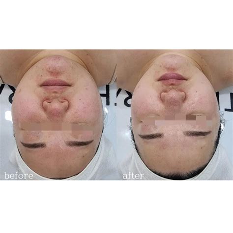 쎄시아뷰티 0228구피1기 반하다패밀리💗 더쎄라 × 에어인시스템 5분으로 10년되돌리기