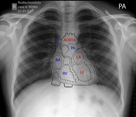 Abnormal Chest Xray