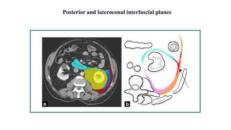 Radioanatomy Of Retroperitoneal Space Pptx Design Fine Art