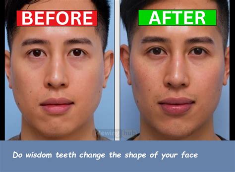 Wisdom Teeth Before And After Face The Joy Of Wisdom Teeth Removal