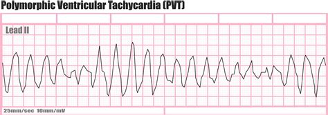 Tachycardia Causes Signs Symptoms Types Diagnosis And Treatment