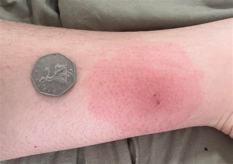 Mosquito Bite Keeps Getting Bigger Starting To Blister Rmedicaladvice