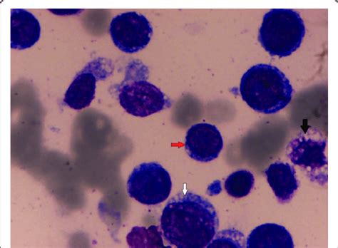 The Erythroid Precursors Show Dysplastic Morphology White Arrow With Download Scientific