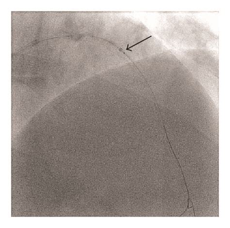 Successful Pci Of The Lad Using Gbat A Diffusely Diseased Proximal Download Scientific
