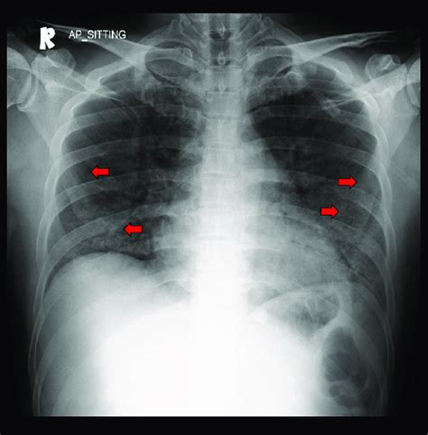 Chest X Ray On July 13 2020 Showed Ground Glass Opacity Areas With