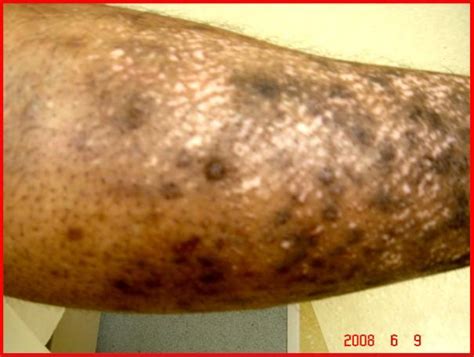 Hyperpigmentation Eczema In Skin Of Color