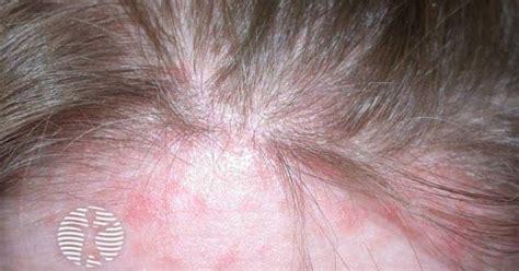Psoriasis Of The Scalp Image