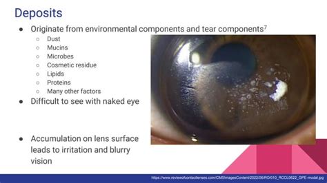 Pathological Myopia And How It Can Effect Cl Rx Ppt