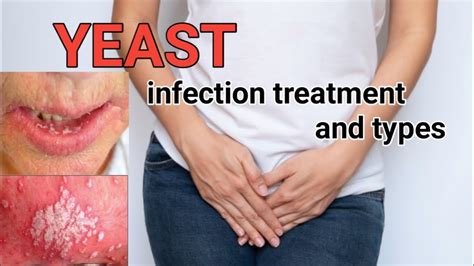 Yeast Fungal Infection Types And Treatment What Is Yeast Infection