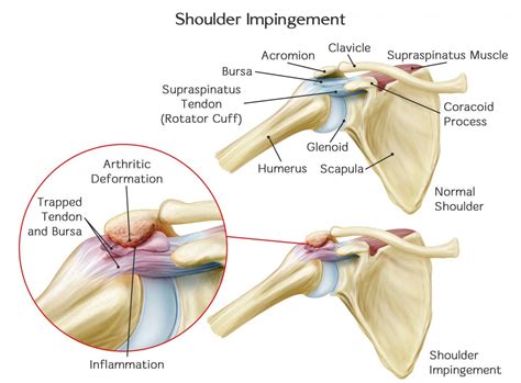 Subacromial Bursitis