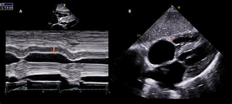 Practical Points For Echocardiography In Cardiac Amyloidosis Journal