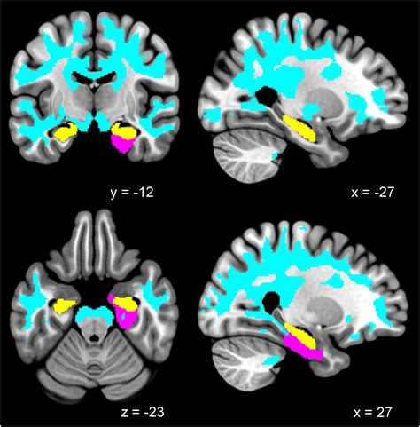 Hyponatremia And The Brain Ground Rules For Nephrologys Feistiest
