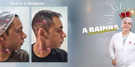 O Guia Completo Dos Cuidados Pós Microagulhamento Em Brasília Para Uma Pele Radiante Sandra