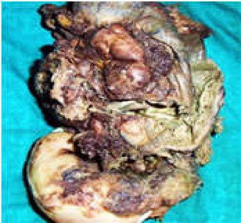 Perforated Appendix Download Scientific Diagram