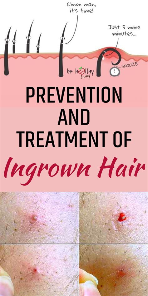 Pin By Ingrown Hair Neck On Medium Length Hair Ingrown Hair Treatment