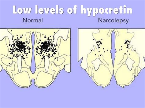 Narcolepsy By Maleana Khounvongsa