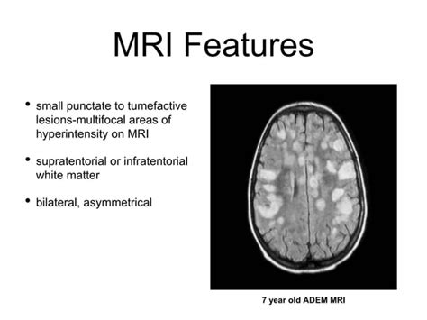 Acute Disseminated Encephalomyelitis Pptx