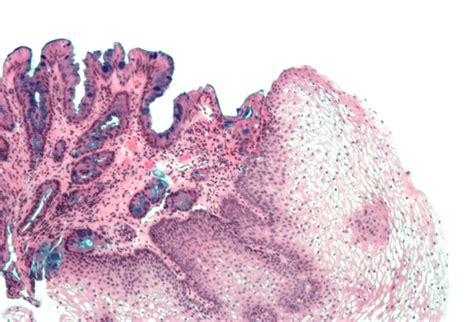 Dysphagia Differential Diagnosis And Case Presentations