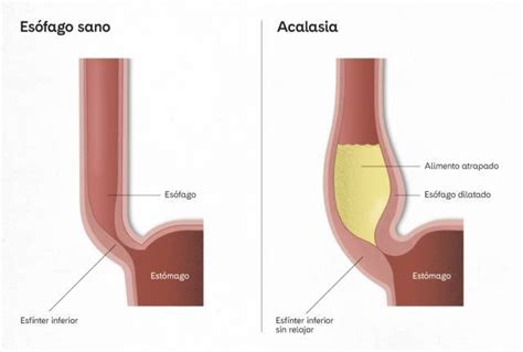 Acalasia ¿qué Es La Acalasia PortalclÍnic
