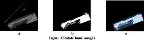 Figure 1 From Design Of A Fracture Detection System Based On Deep Program In A Convolutional