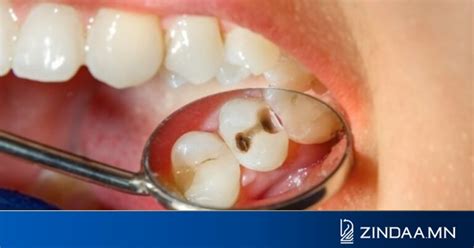 СЭДЭВ I 0 18 насны хүүхдүүдийн 61 5 нь ШҮД ЦООРОЛТТОЙ байна