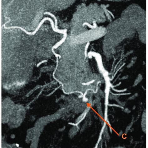 3d Maximum Intensity Projection Reconstruction Of The Computed Download Scientific Diagram