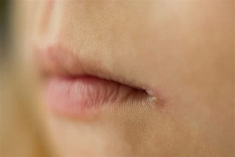 How To Get Rid Of Dry Skin In Corner Of Mouth At Catherine Reeves Blog