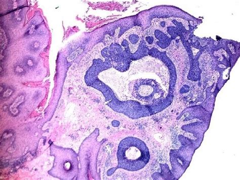 Bcc Aggregates Of Basaloid Epithelial Cells With Peripheral Palisading Download Scientific