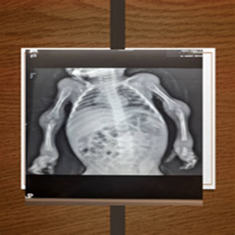 X Ray Shows Subcutaneous Calcifications Over The Skull Download Scientific Diagram