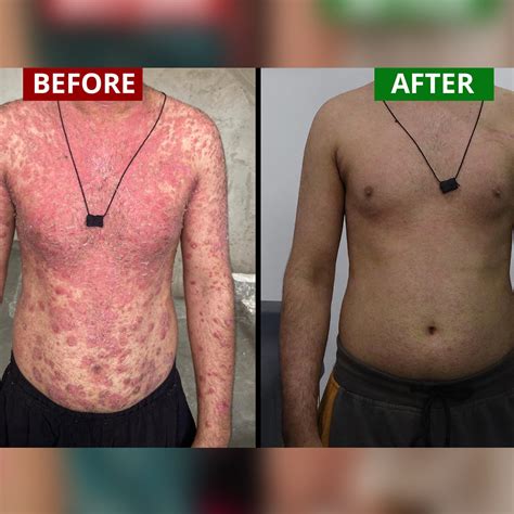 Psoriasis Care Complete Relief Kit