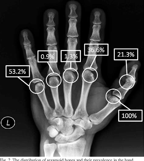 Figure 4 From Prevalence And Distribution Of Sesamoid Bones Of The Hand