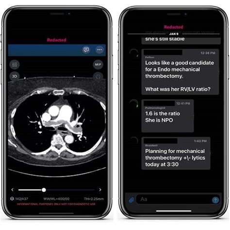 Viz Ai On Linkedin 🚀 Exciting Advancements In Pulmonary Embolism Pe Detection This Latest…