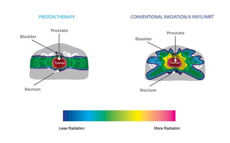 Proton Beam Therapy Tennessee Oncology Proton Center