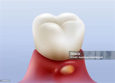 Purulent Gingivitis Stock Illustration Download Image Now Bacterium