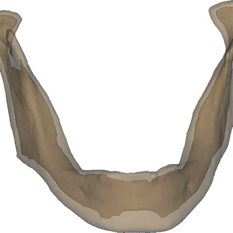 Meshing And Fixation Of The Finite Element Analysis Fea Model The Download Scientific
